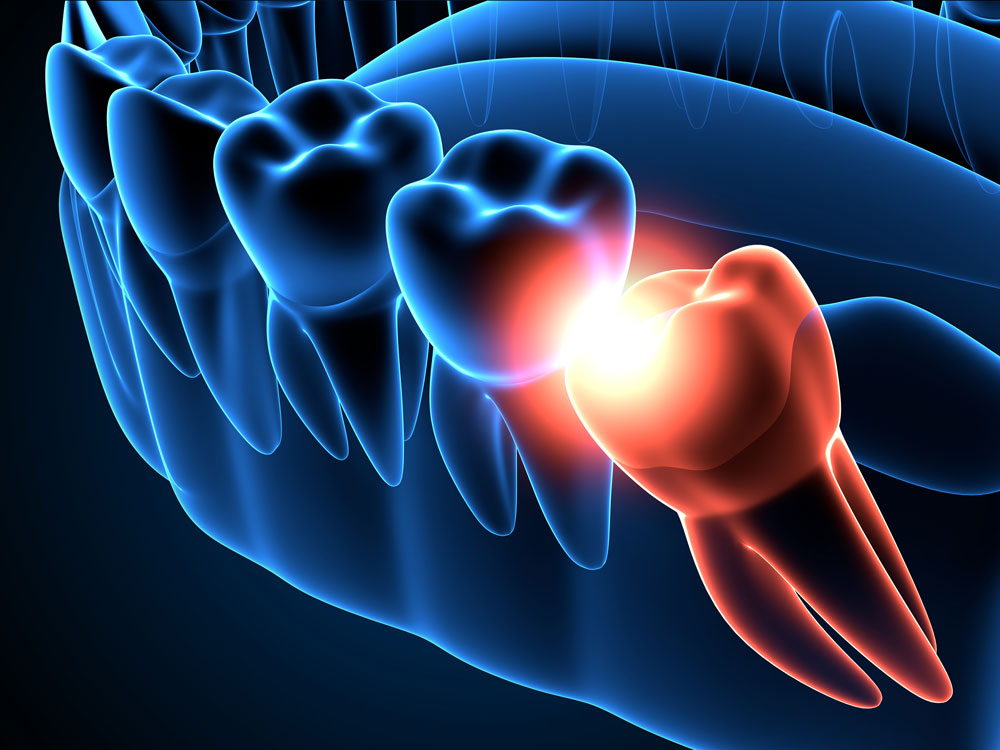 Wisdom Teeth Removal: How Late is Too Late?